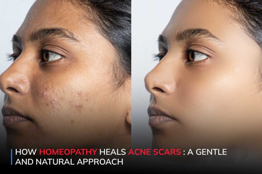 How Homeopathy Heals Acne Scars: A Gentle and Natural Approach